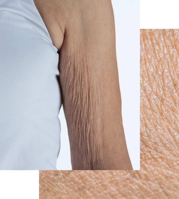 Crepey Skin Body Treatment | Learn About The Bodyfirm - The BodyFirm